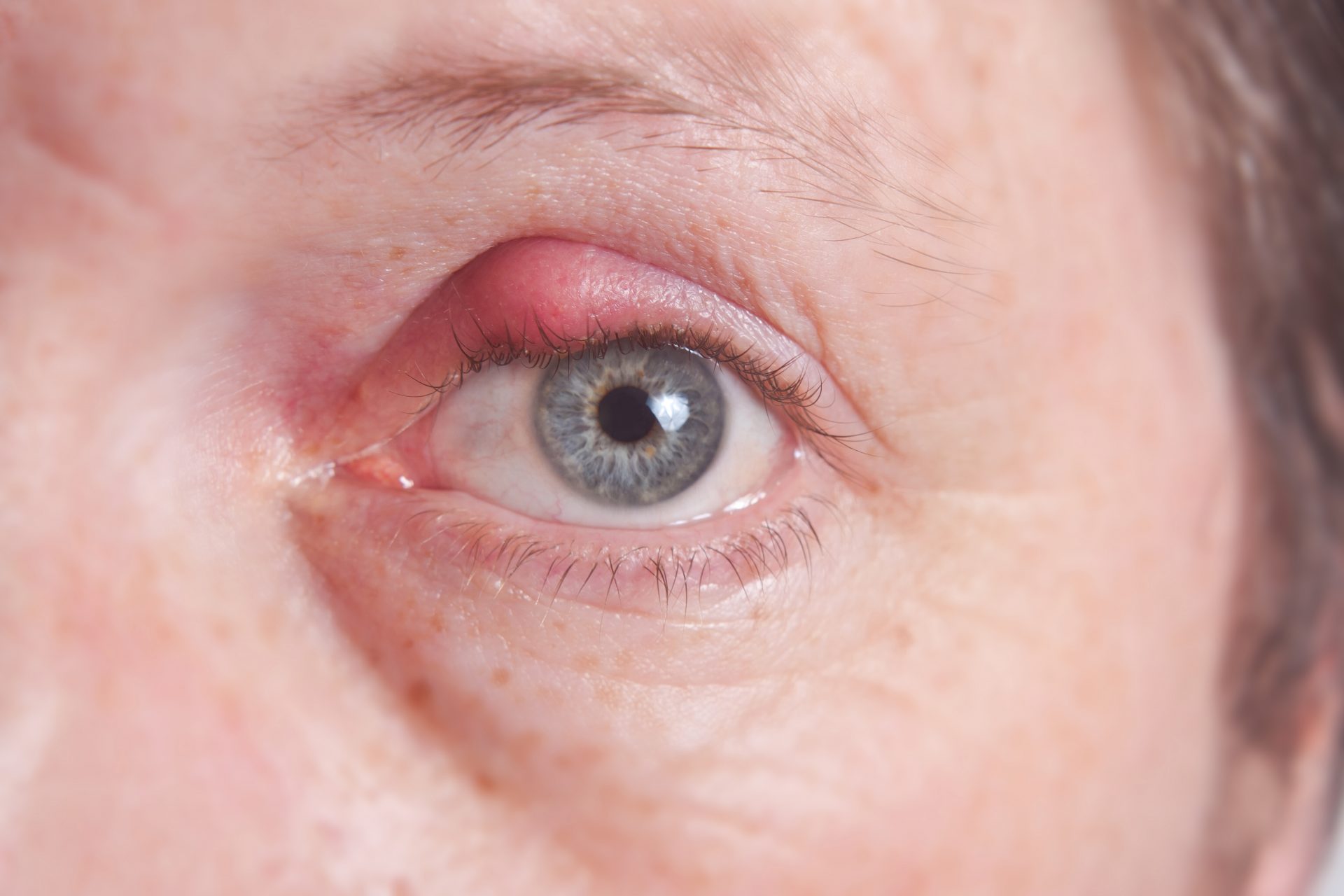 Expert suggested ways to prevent eye pimple or stye - Yabibo