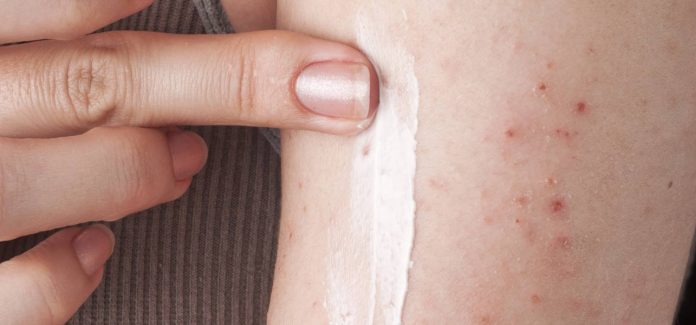 5 Ways to Treat Chigger Bites - Yabibo