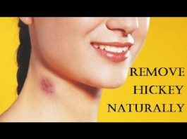 Best 8 home remedies to Get Rid of Hickeys Fast - Yabibo
