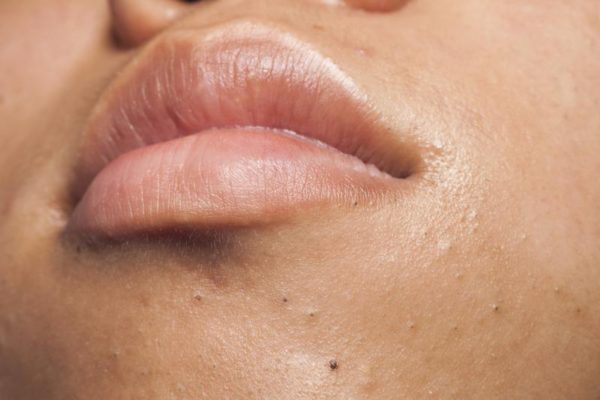 How to get rid of oil bumps naturally? - Yabibo
